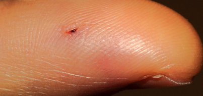 What Happens If A Mouse Bites You? Remedies | Pestclue